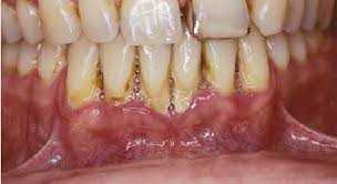 Sintomas Bucais da AIDS Zona Sul SP - Odontologia Apeles lemos