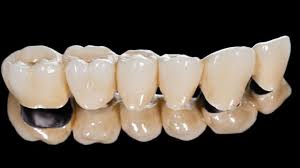 Próteses Dentárias Fixas Zona Sul SP - Odontologia Apeles Lemos